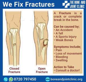 Bone Fractures – The Bone and Joint Clinic